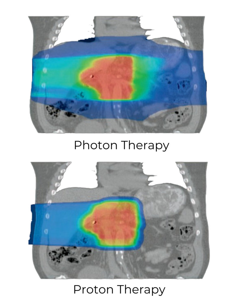 The Use of Proton Therapy in the Treatment of Cancers in Adolescents ...